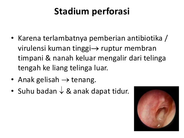 Otitis media akut