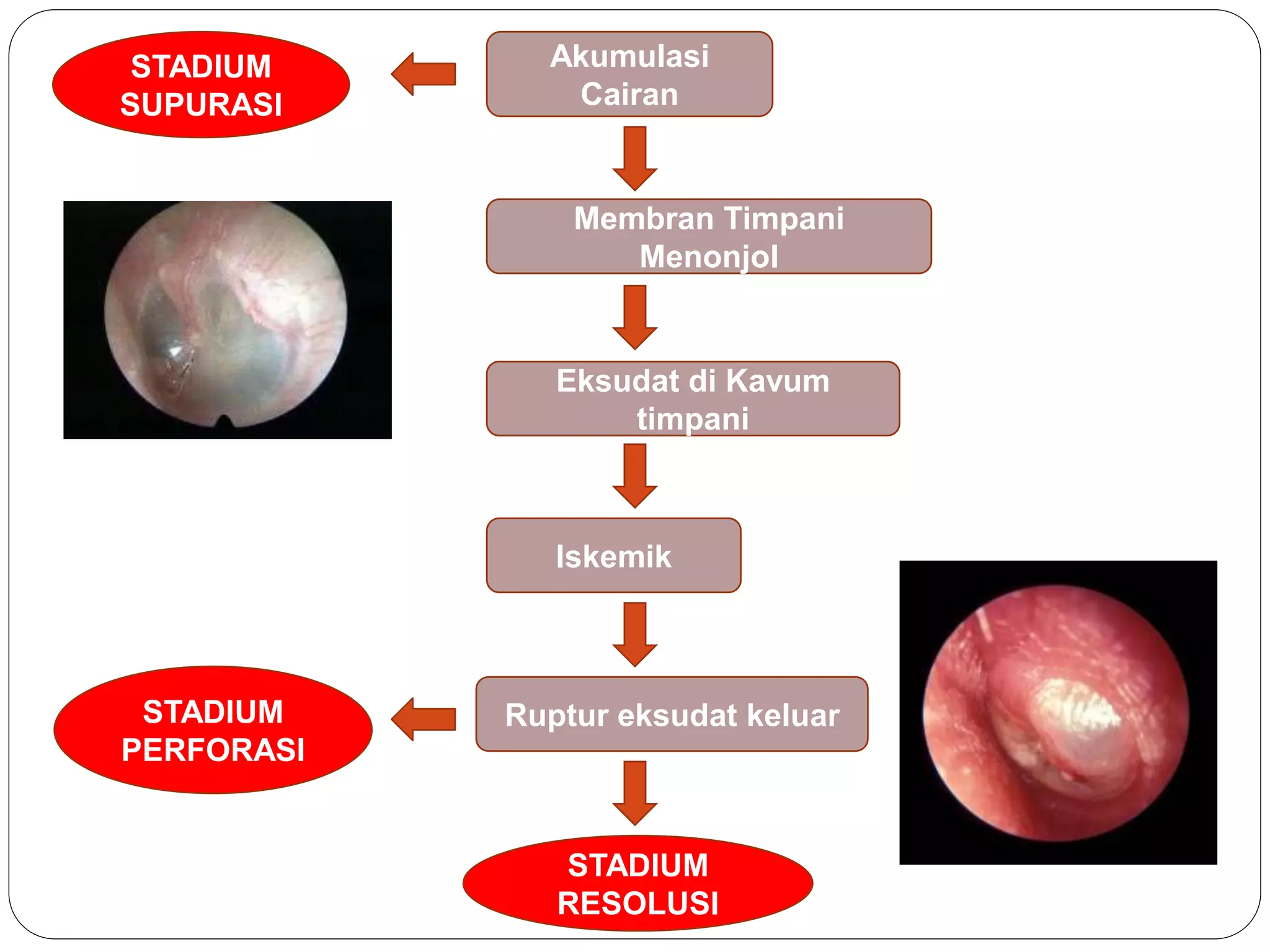 Otitis media akut | PPTX