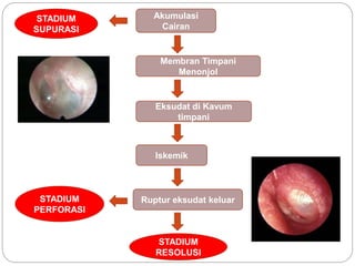Otitis media akut | PPTX