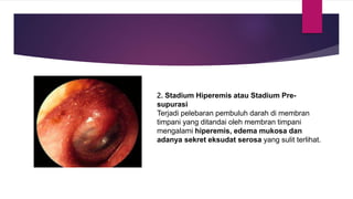 otitis Media Akut.pptx