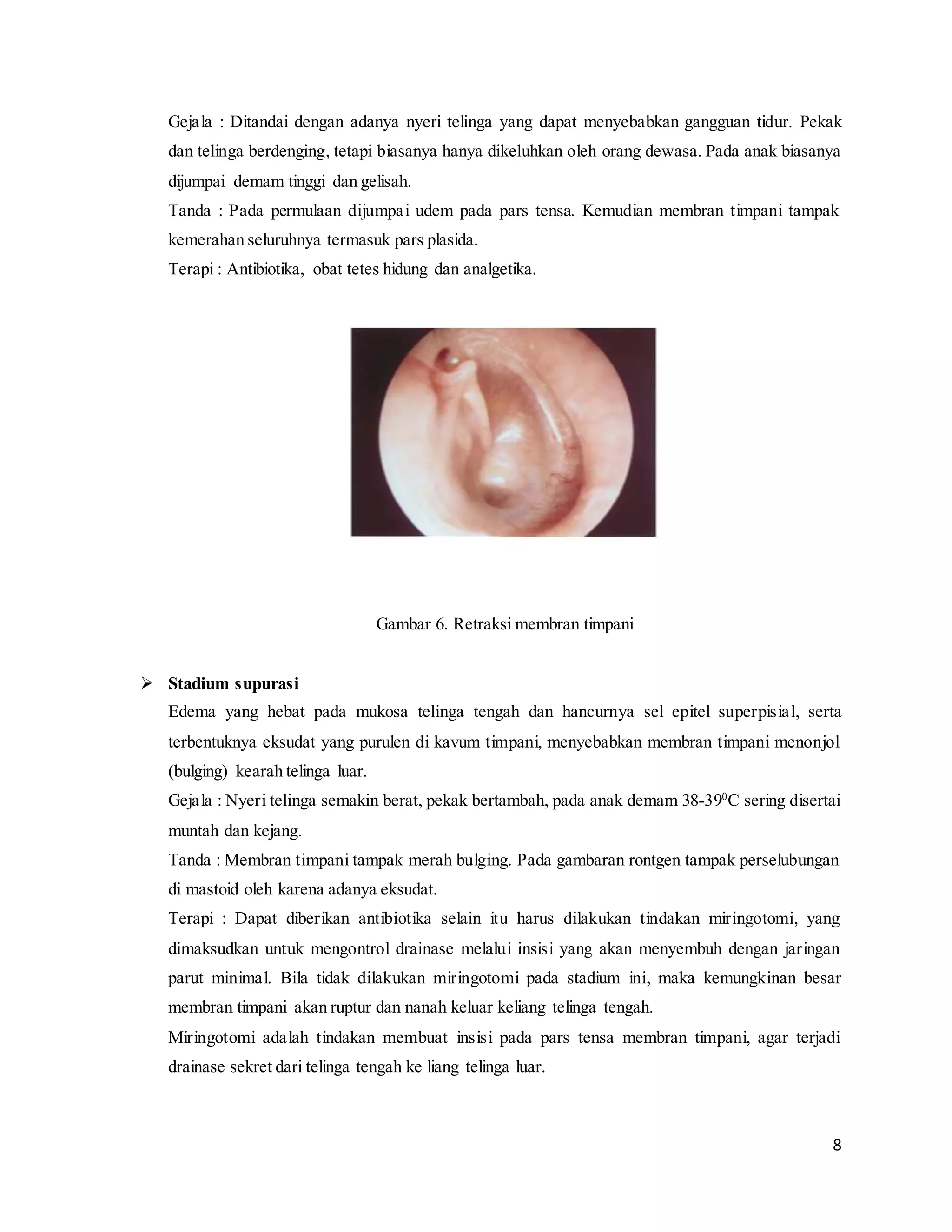 Otitis media akuta | DOCX