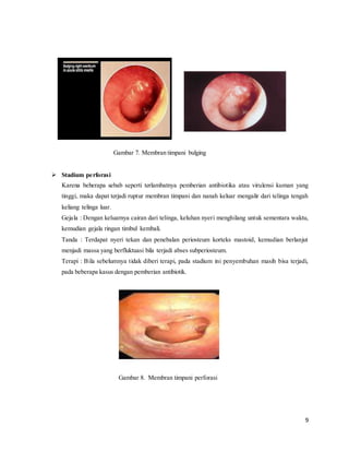 Otitis media akuta | DOCX