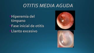 Otitis media | PPTX
