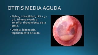 Otitis media | PPTX