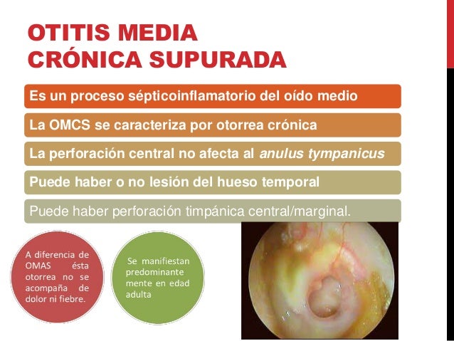 Otitis Media The Scope