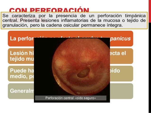 Otitis media crónica