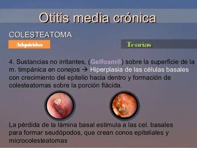 Otitis media crónica