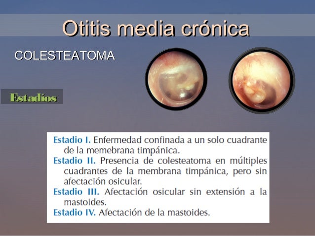 Otitis media crónica