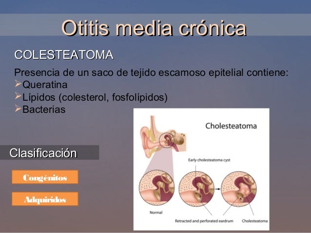 Otitis media crónica