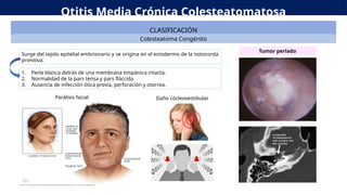 OTITIS MEDIA CRÓNICA - ACTUALIZADO (2024) | PPTX
