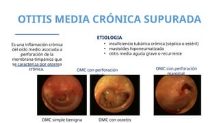 OTITIS MEDIA CRÓNICA - ACTUALIZADO (2024) | PPTX