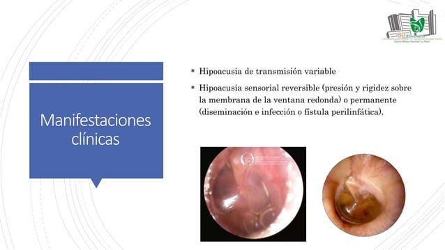 Otitis Media Crónica Con Derrame
