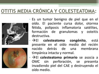 Otitis media cronica | PPTX
