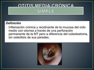 Otitis Media Crónica | PPTX | Ear, Nose and Throat Conditions ...