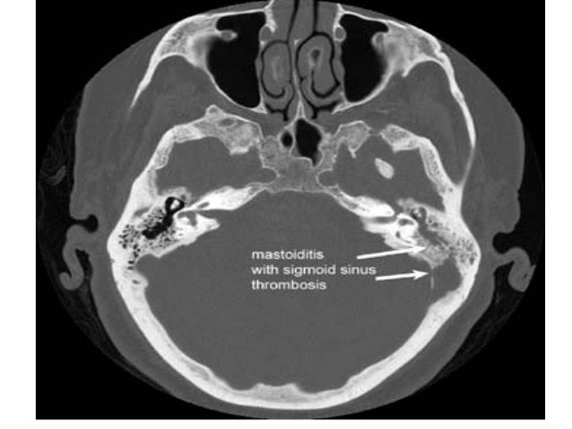 otitis media by Abu Sayeed Ansari