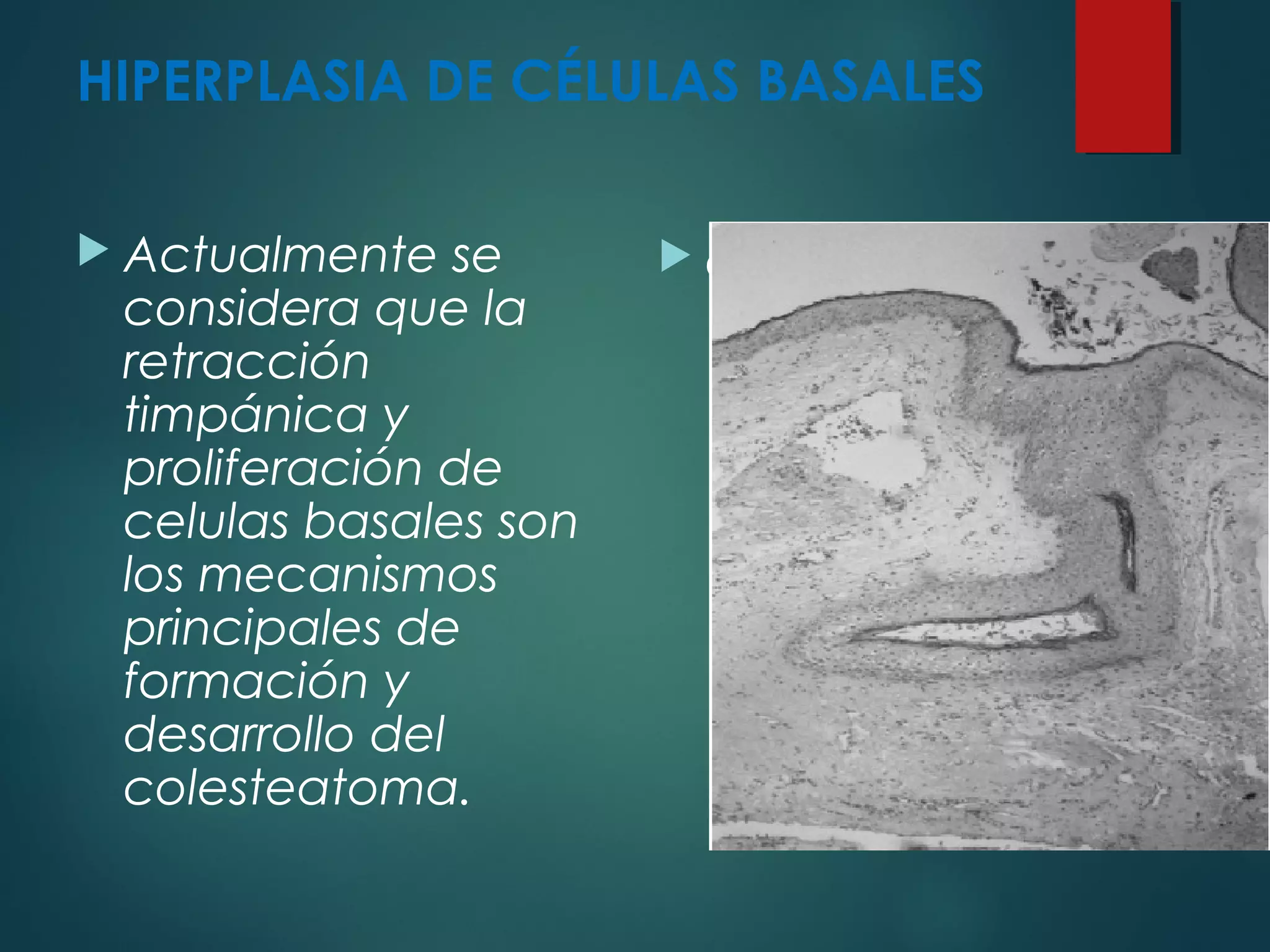 OTITIS MEDIA CRONICA COLESTEATOMA | PPT