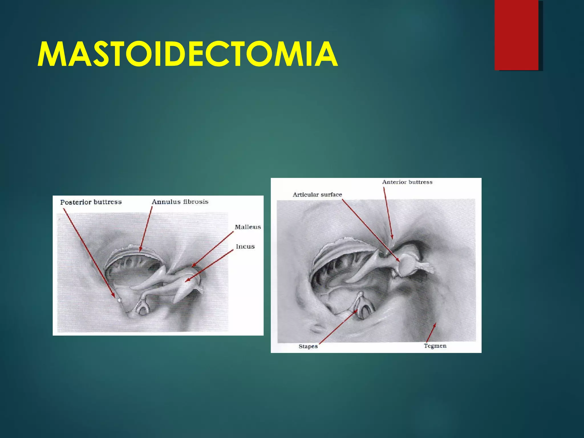 OTITIS MEDIA CRONICA COLESTEATOMA | PPT