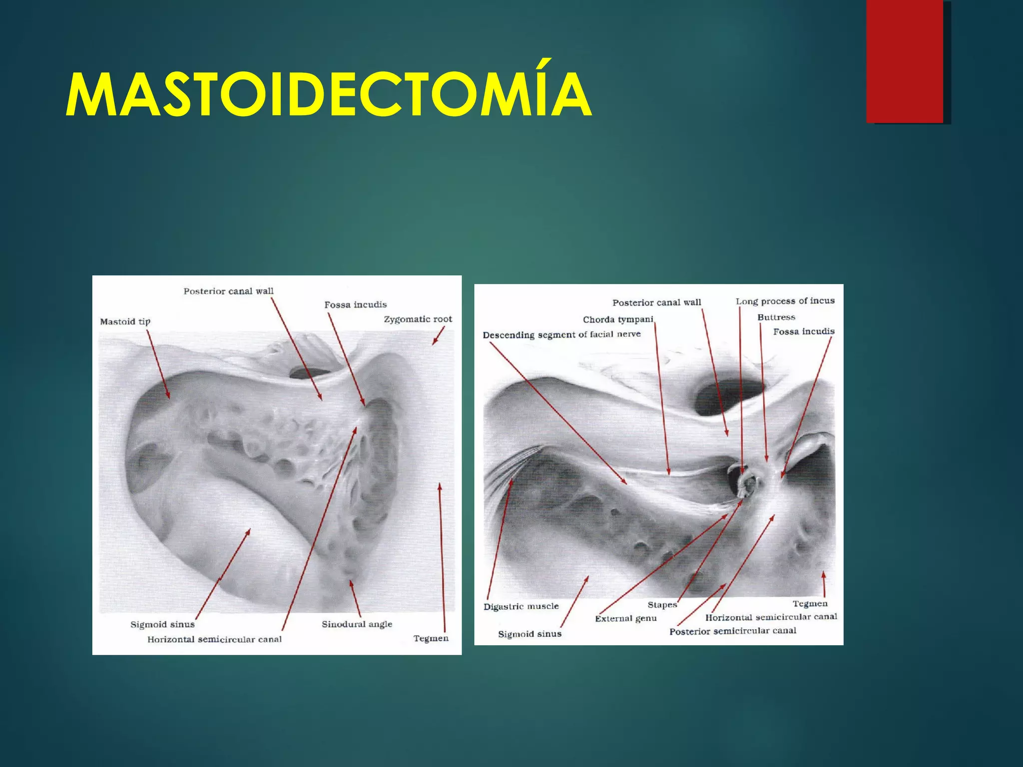 OTITIS MEDIA CRONICA COLESTEATOMA | PPT
