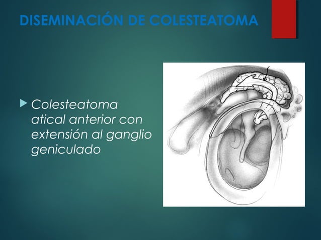 OTITIS MEDIA CRONICA COLESTEATOMA | PPT