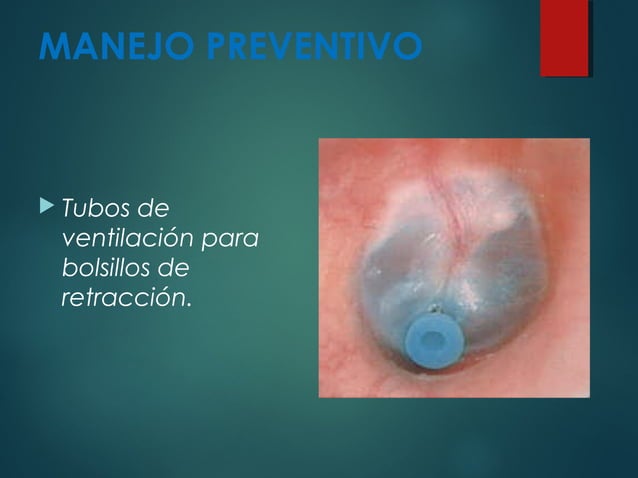 OTITIS MEDIA CRONICA COLESTEATOMA | PPT