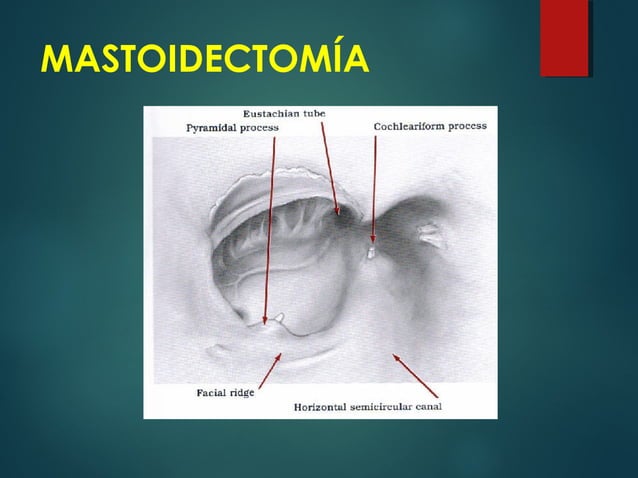 OTITIS MEDIA CRONICA COLESTEATOMA | PPT