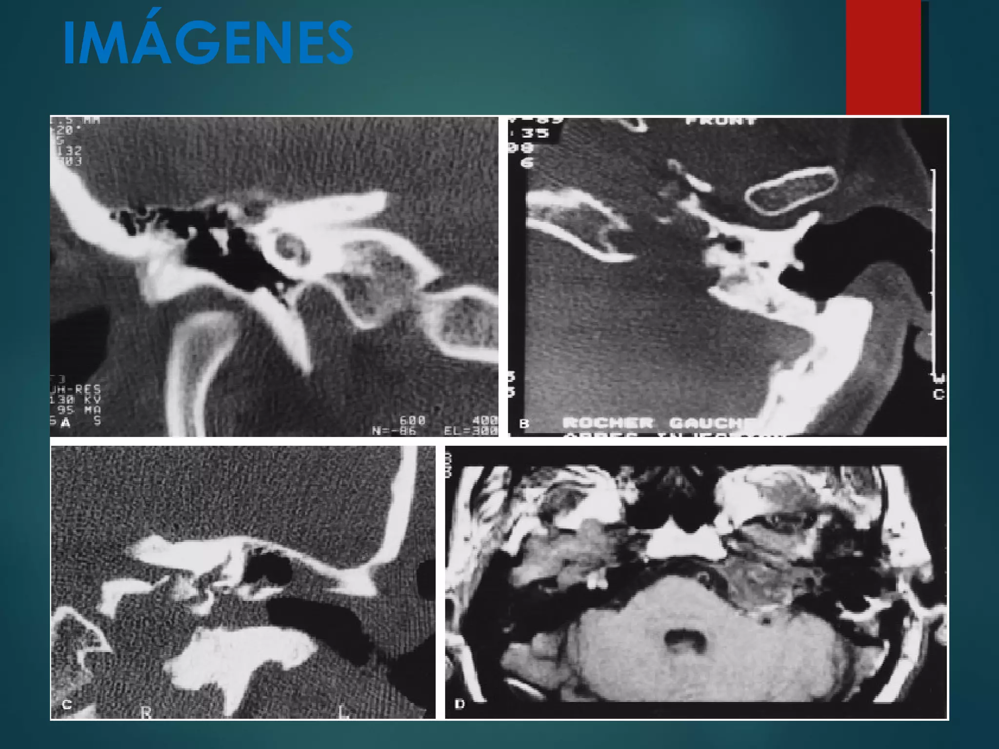 OTITIS MEDIA CRONICA COLESTEATOMATOSA-DR. OMAR GONZALES SUAZO | PPT