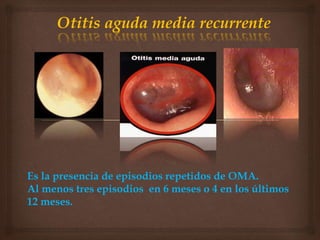 Otitis Media Crónica