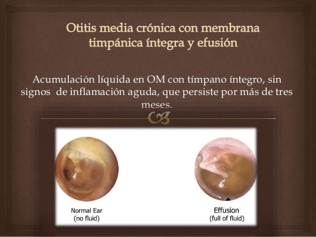 Derrame Da Membrana Timpanica