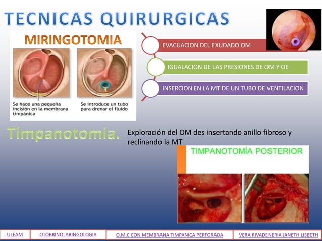 Otitis media cronica con membrana timpanica perforada | PPT