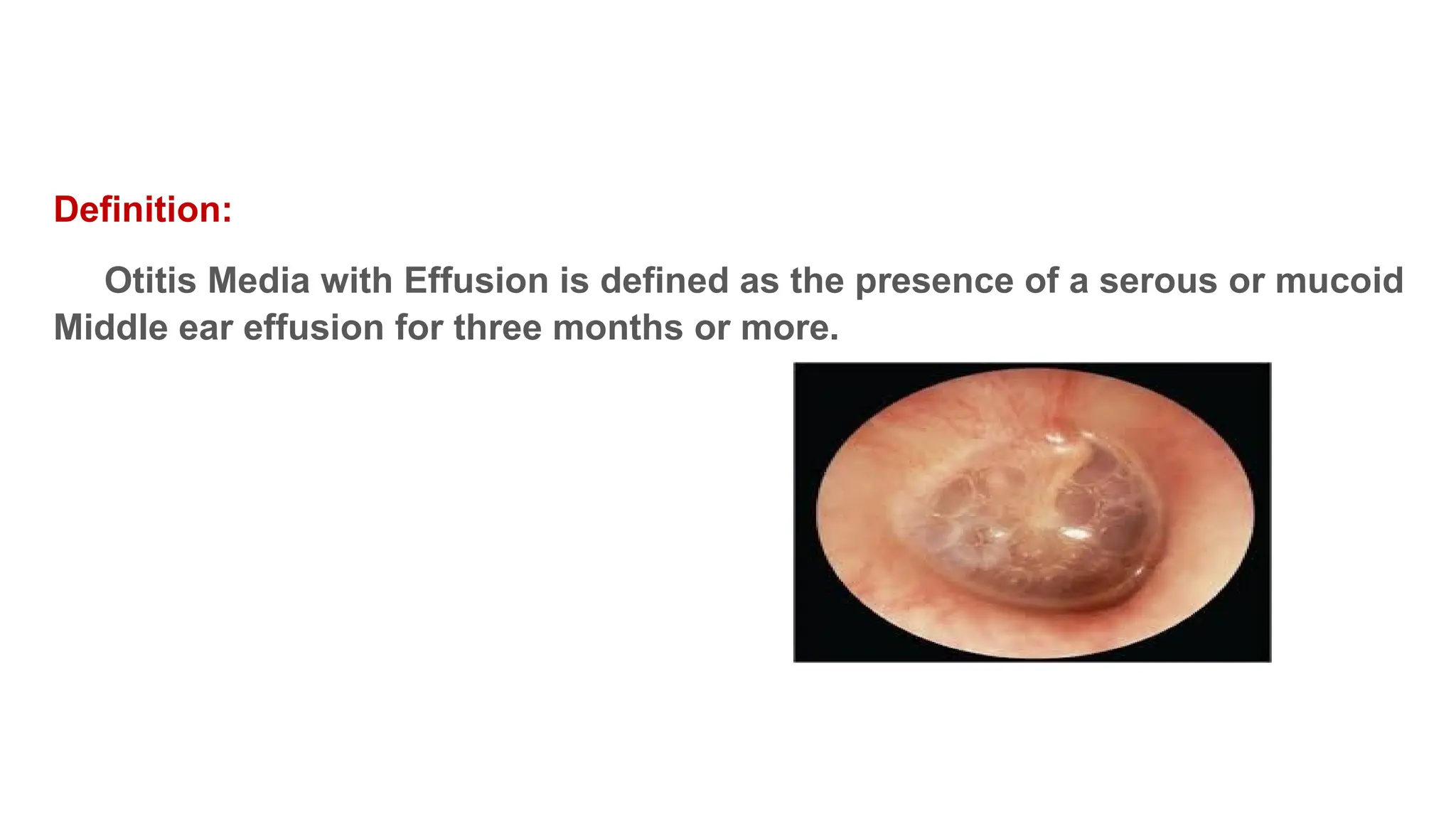 OTITIS MEDIA EFFUSION tube dysfunction -.pptx