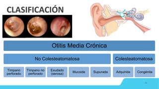 Clasificacion De Otitis Media – Classification and criteria of otitis ...