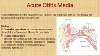acute and chronic otitis media for undergraduates.pptx