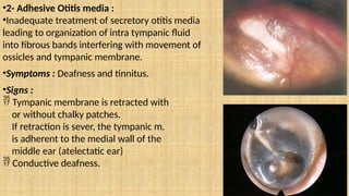 acute and chronic otitis media for undergraduates.pptx