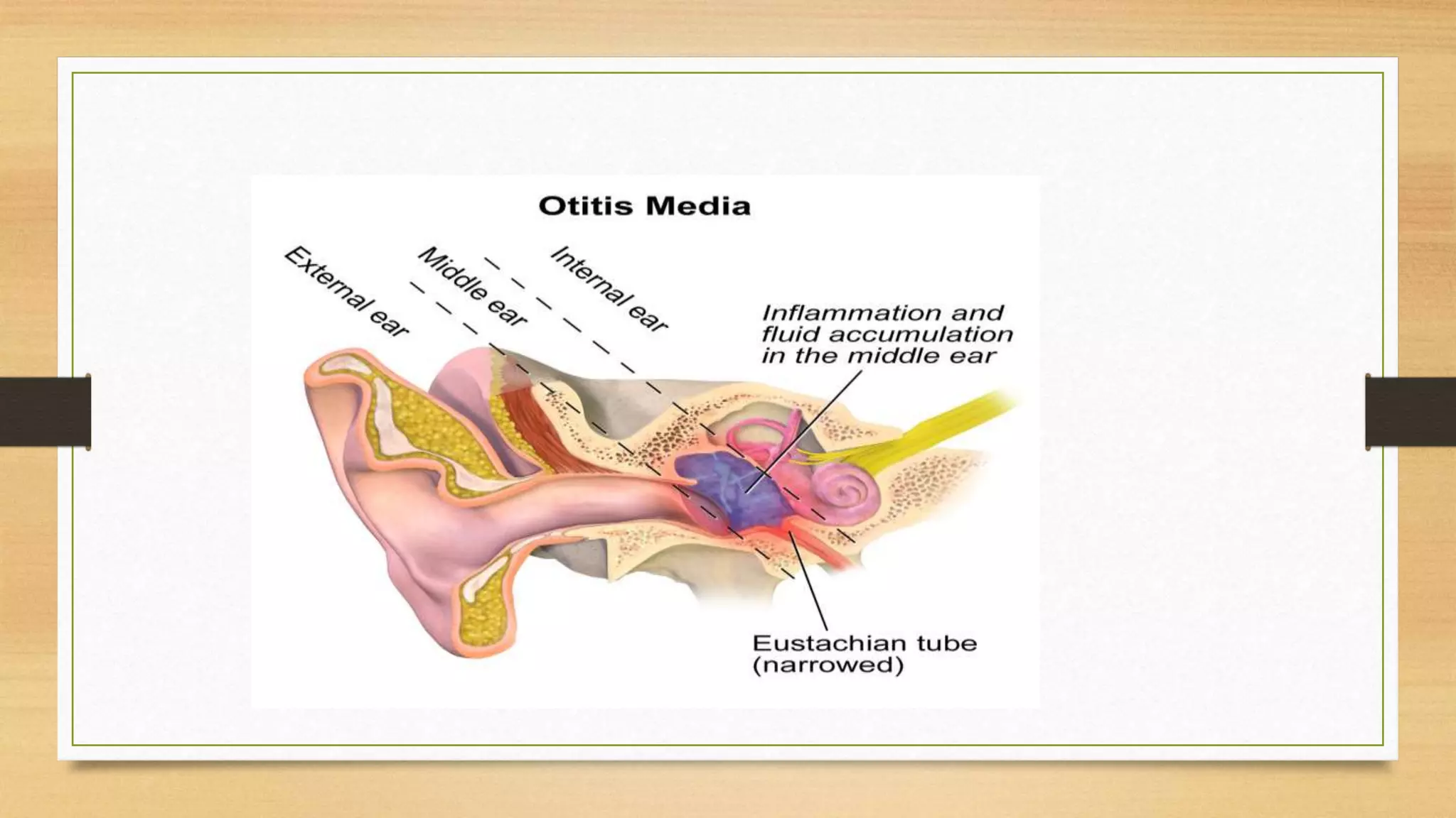 Otitis media ppt | PPTX