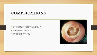 Otitis media ppt | PPTX