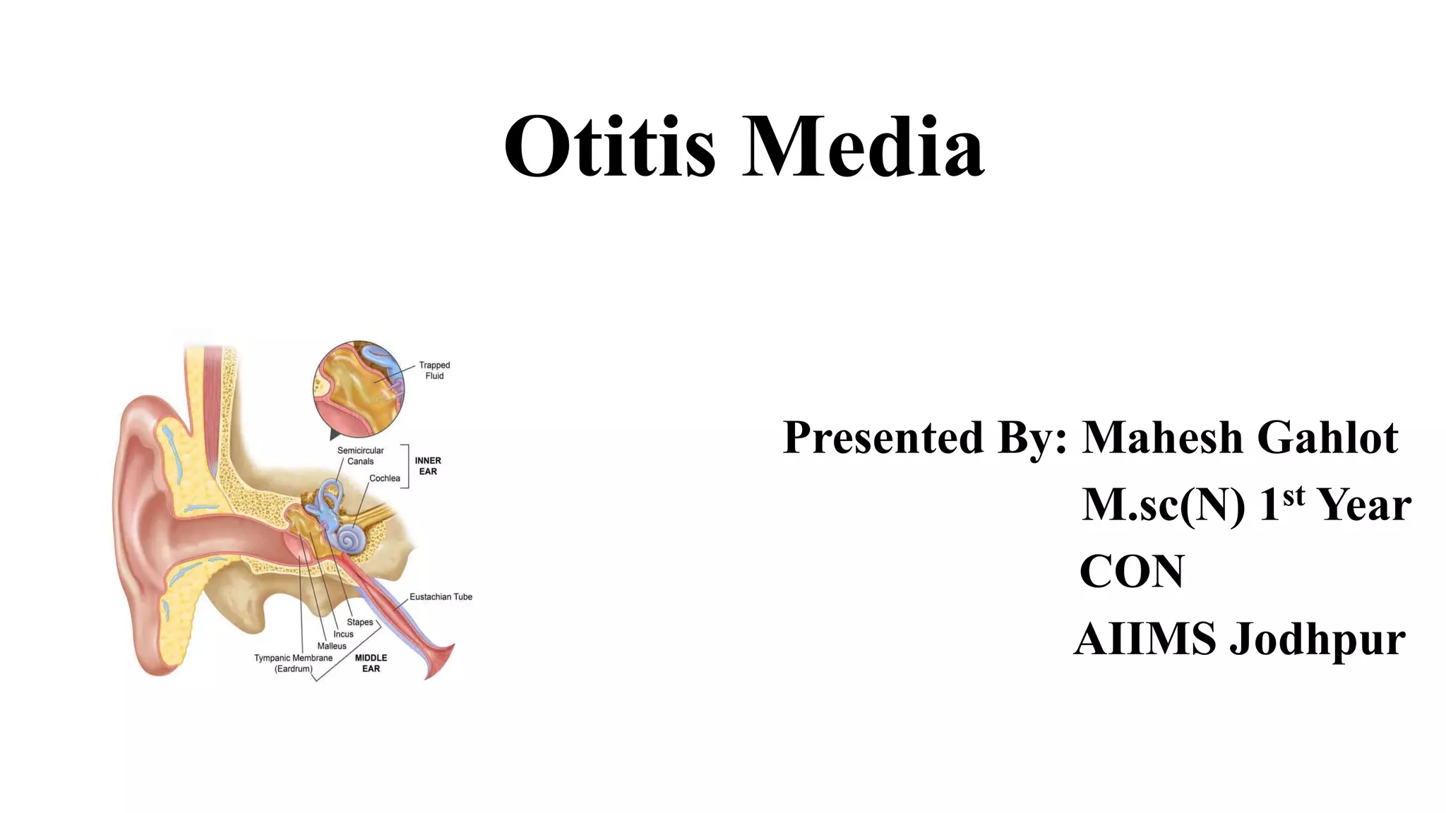 Otitis media in children | PPTX