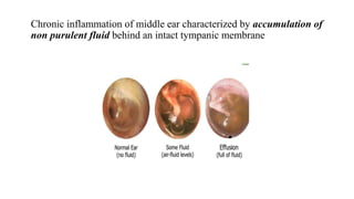 Otitis media in children | PPTX