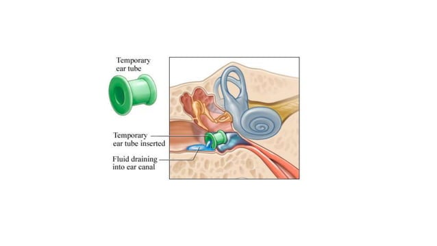 Otitis media in children | PPTX | Ear, Nose and Throat Conditions ...