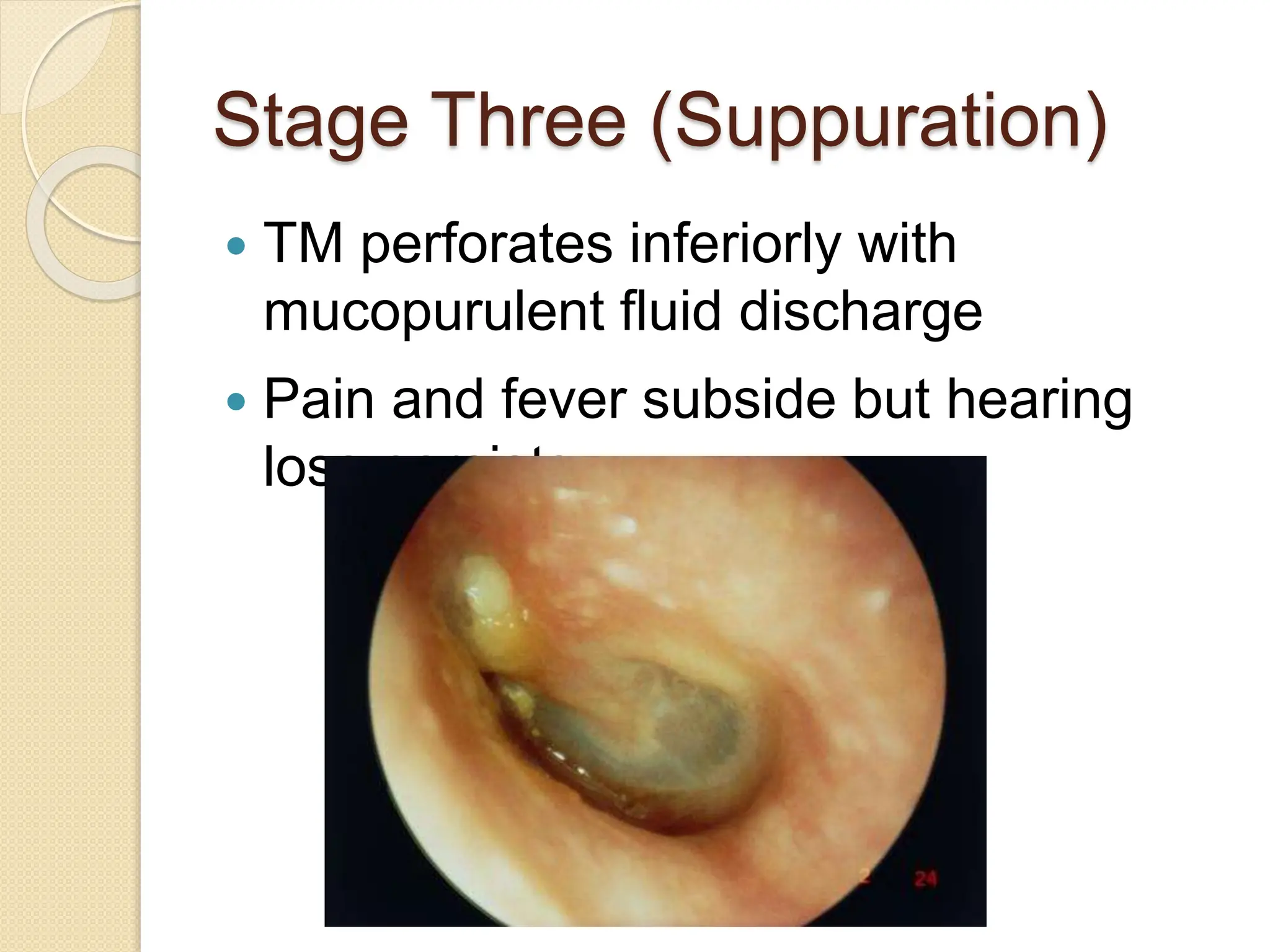 Otitis Media ppt .pptx