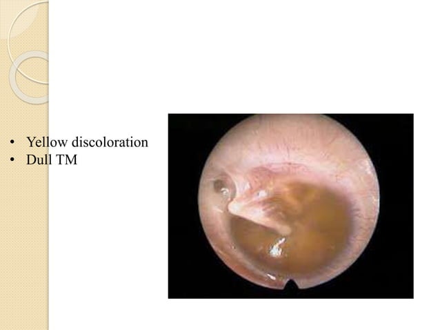 Otitis Media ppt .pptx