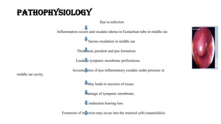 Otitis Media in Children ||PPT|| SlideShare | PPTX