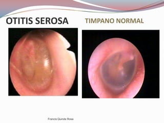 Otitis media serosa | PPT