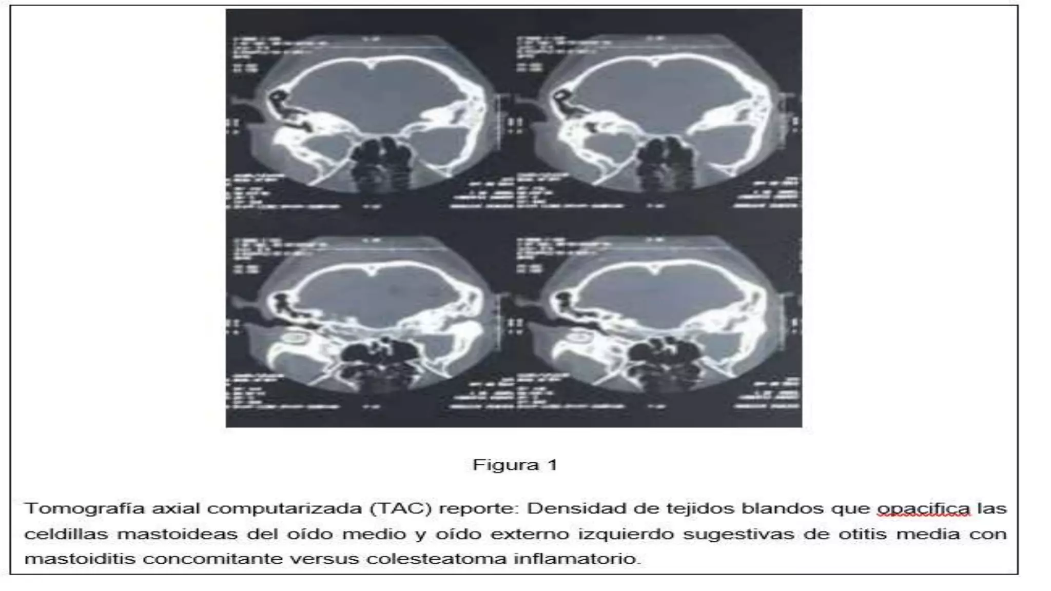 Otitis media serosa.pptx