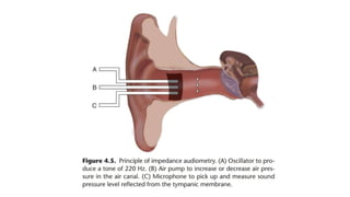 Otitis media with effusion | PPTX