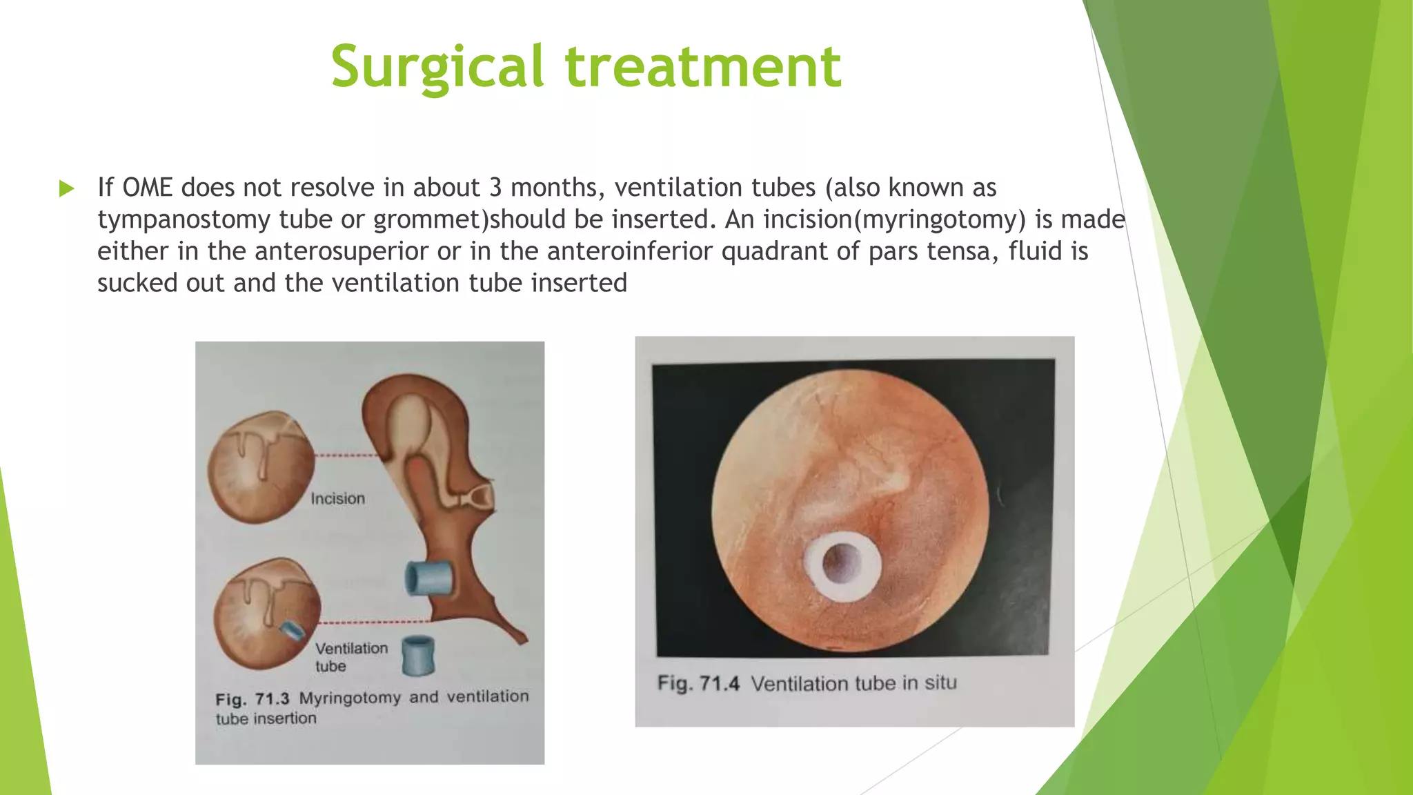 Otitis Media With Effusion.pptx