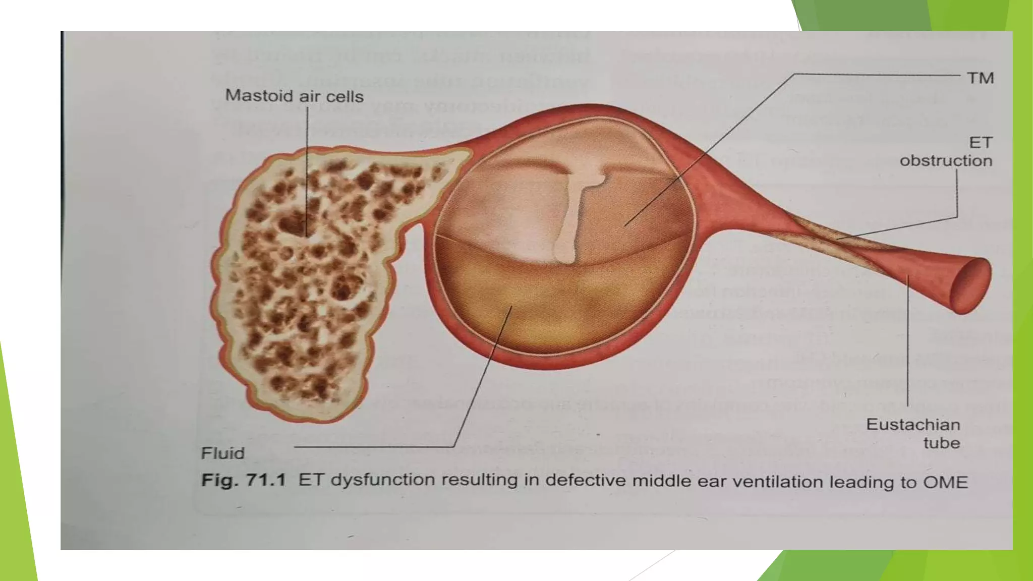 Otitis Media With Effusion.pptx