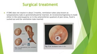 Otitis Media With Effusion.pptx