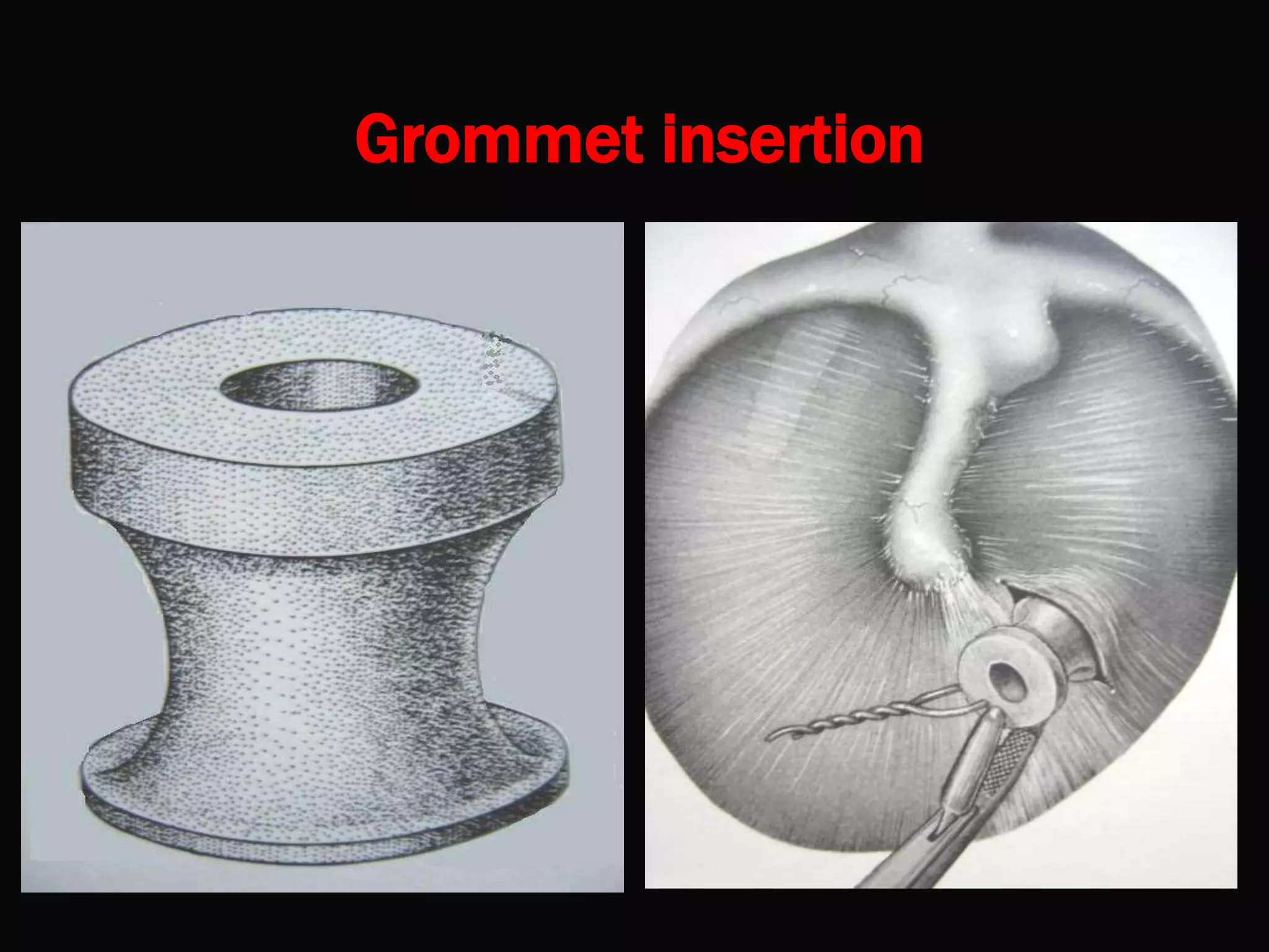 Otitis Media With Effusion (OME) | PPT