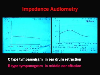 Otitis Media With Effusion (OME) | PPT