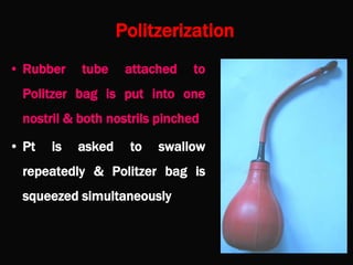 Otitis Media With Effusion | PPT